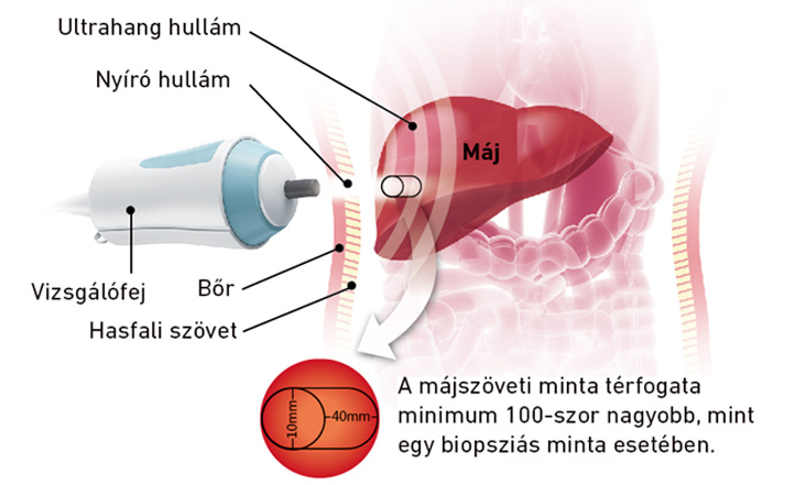 iLiV Touch FT100 hepatológiai diagnosztikai berendezés – Hyppo Labor